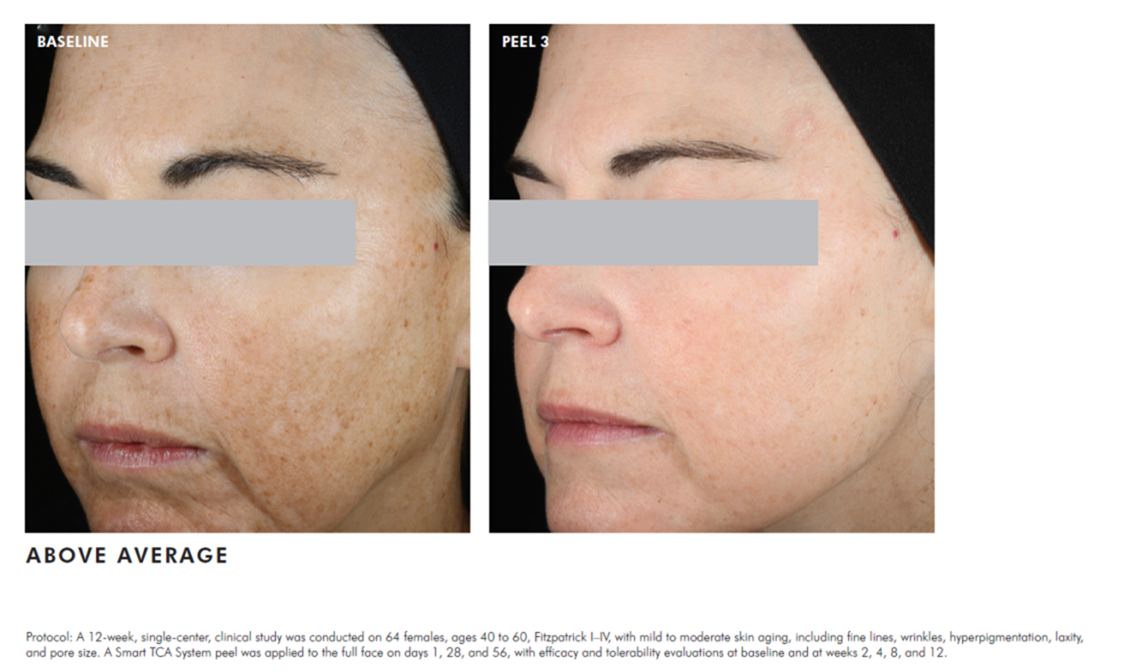 SkinCeuticals Smart TCA Peel | The Medi Spa by Graham Dermatology